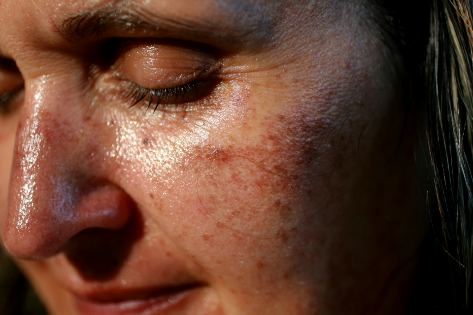 Iperpigmentazioni cutanee: come combattere e prevenire le macchie della ...