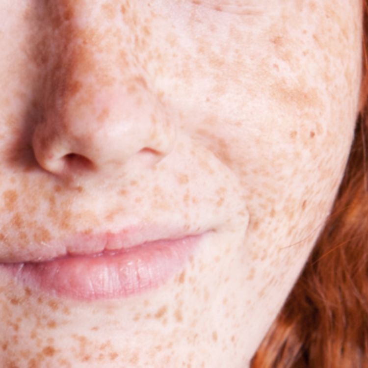 Iperpigmentazione » Moody Skin - Skincare Coreana